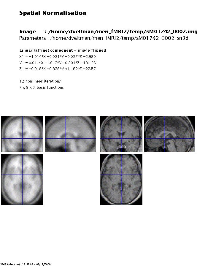 Display : spm_sn3d displays the normalised image and the template ...