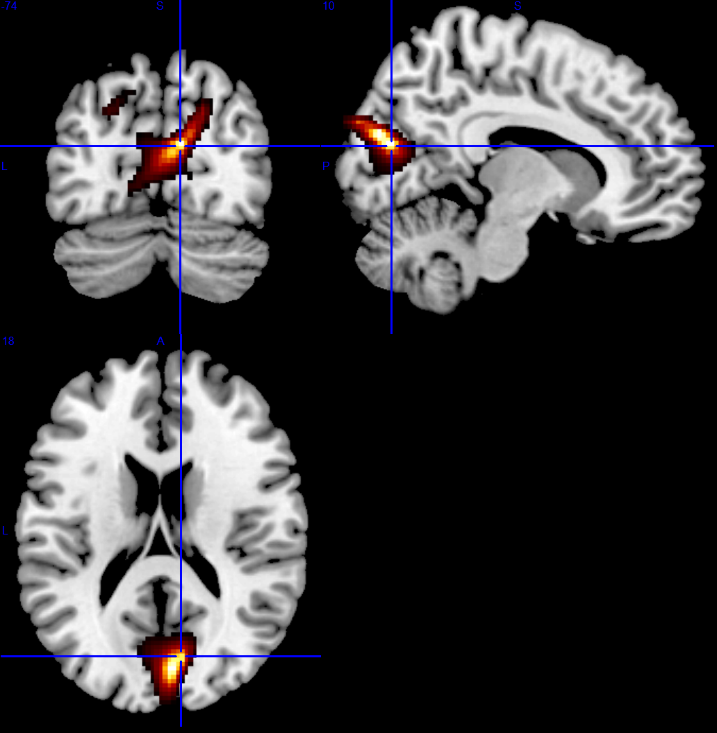 Source level: Evoked response - SPM Documentation